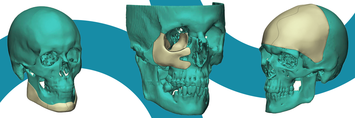 Patient-Specific Implants | Poriferous Surgical Implants
